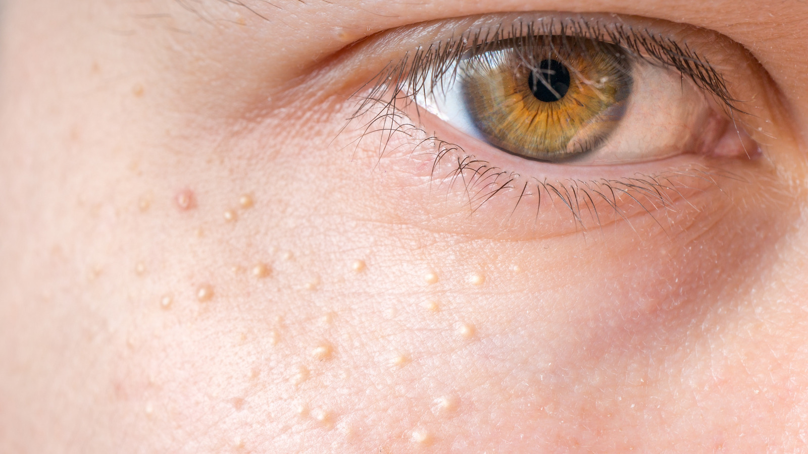 Here's How To Get Rid Of Milia Under Your Eyes