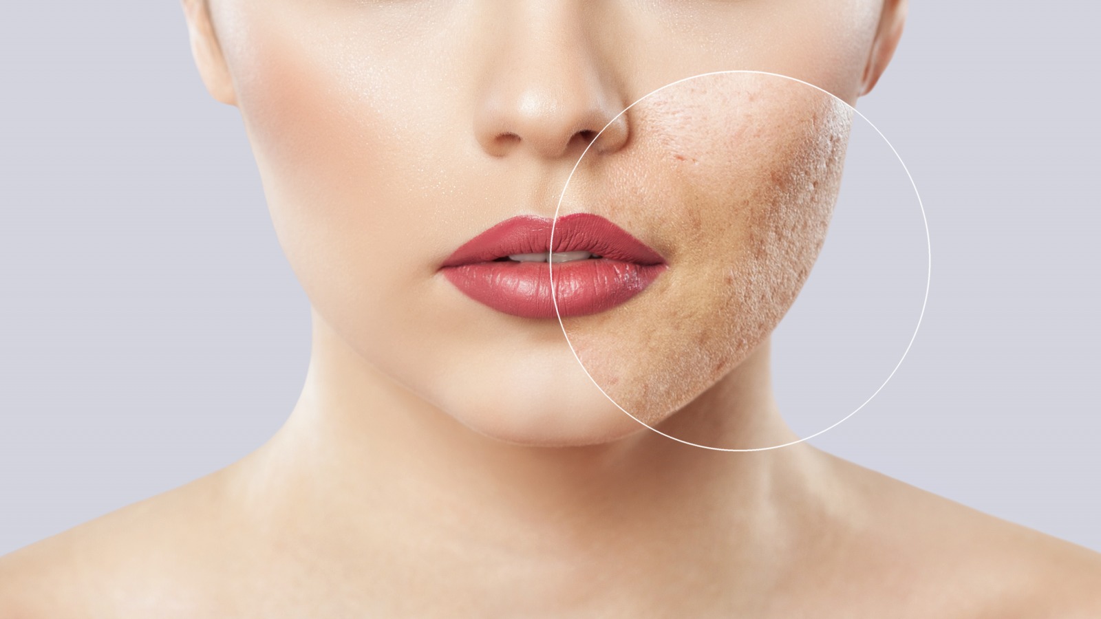 Here's What Chin Acne Is Telling You About Your Health