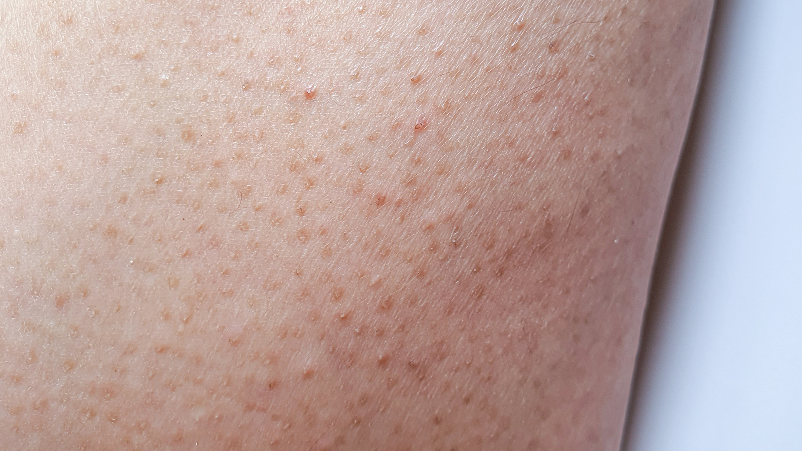 Here s Why You Have Little Bumps On Your Arms Here s Why You Have Little Bumps On Your Arms