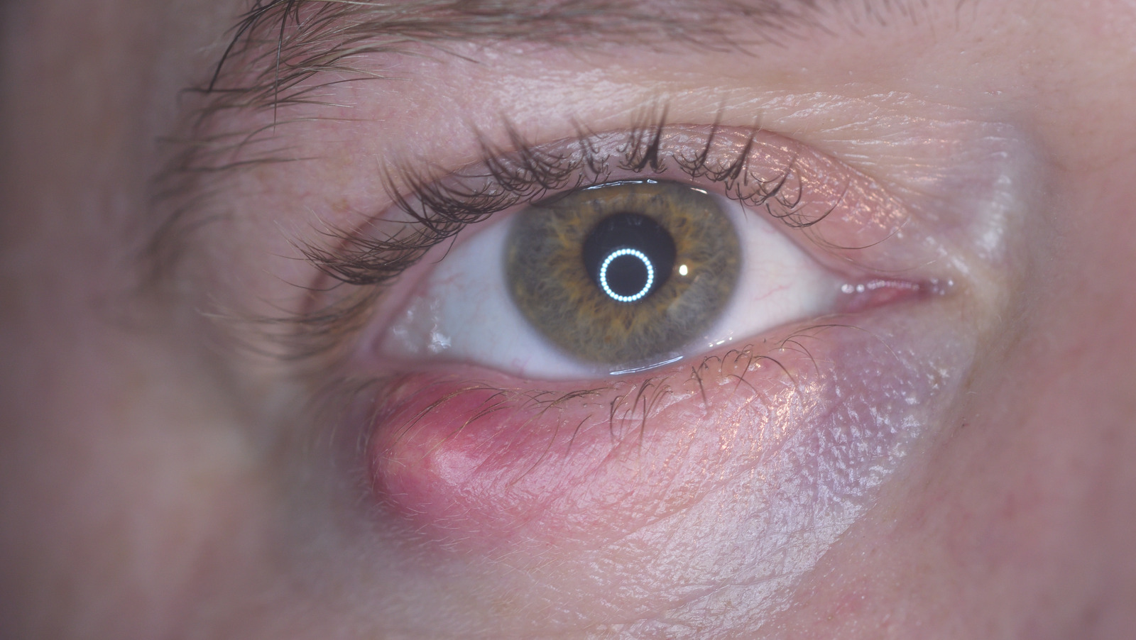 How To Get Rid Of A Stye How To Get Rid Of A Stye