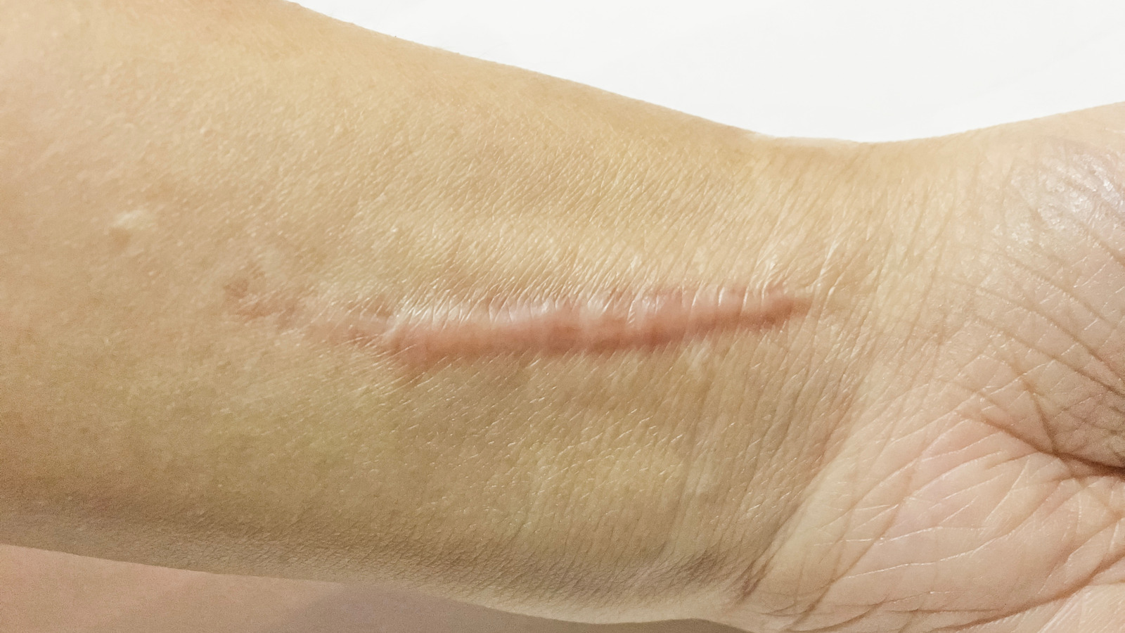 How To Tell If You Have A Hypertrophic Or A Keloid Scar How To Tell If You Have A Hypertrophic Or A Keloid Scar