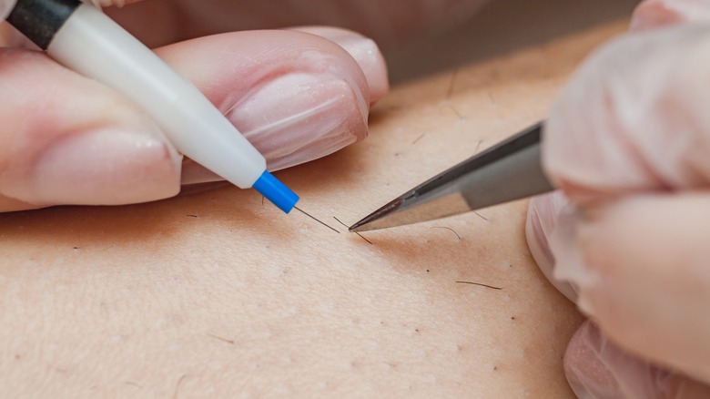 Is It Possible To Achieve Permanent Hair Removal And If So How 